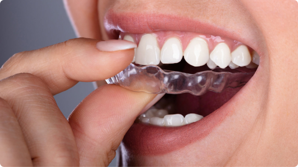 Splints and Appliances | Clear Sequential Aligners | Invisalign ...