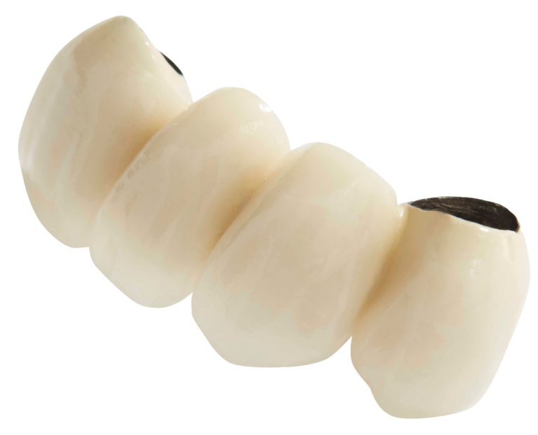 Non-metal CERAMAGE® crowns and bridgework | Southern Cross Dental