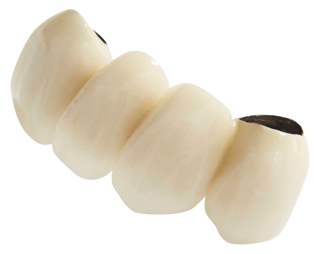 Metal Ceramic Bridge