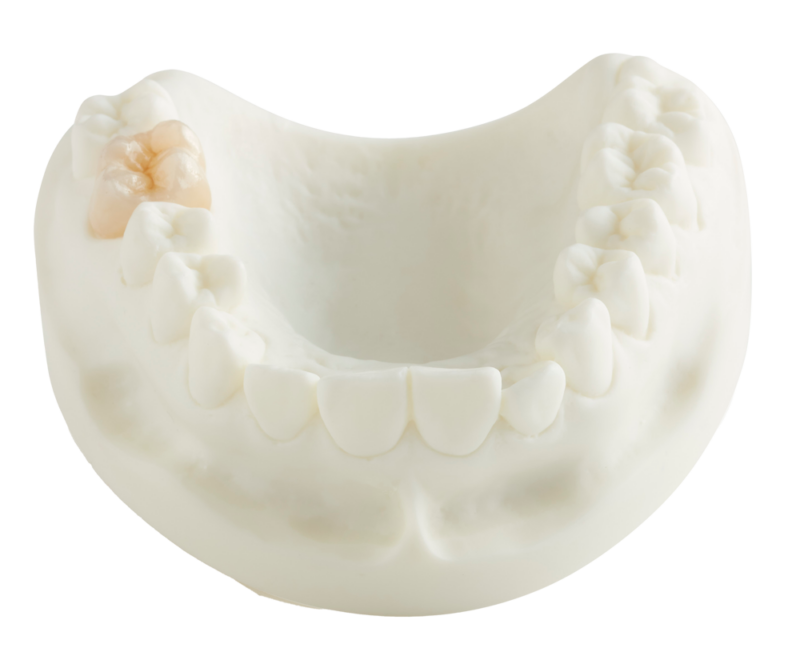 Non-metal CERAMAGE® crowns and bridgework | Southern Cross Dental