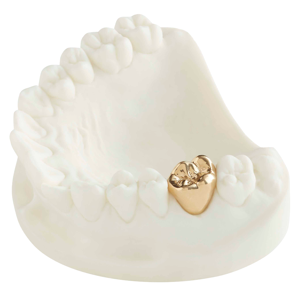 Crown and Bridgework - Metal | Porcelain Crown | Gold Tooth Crown ...