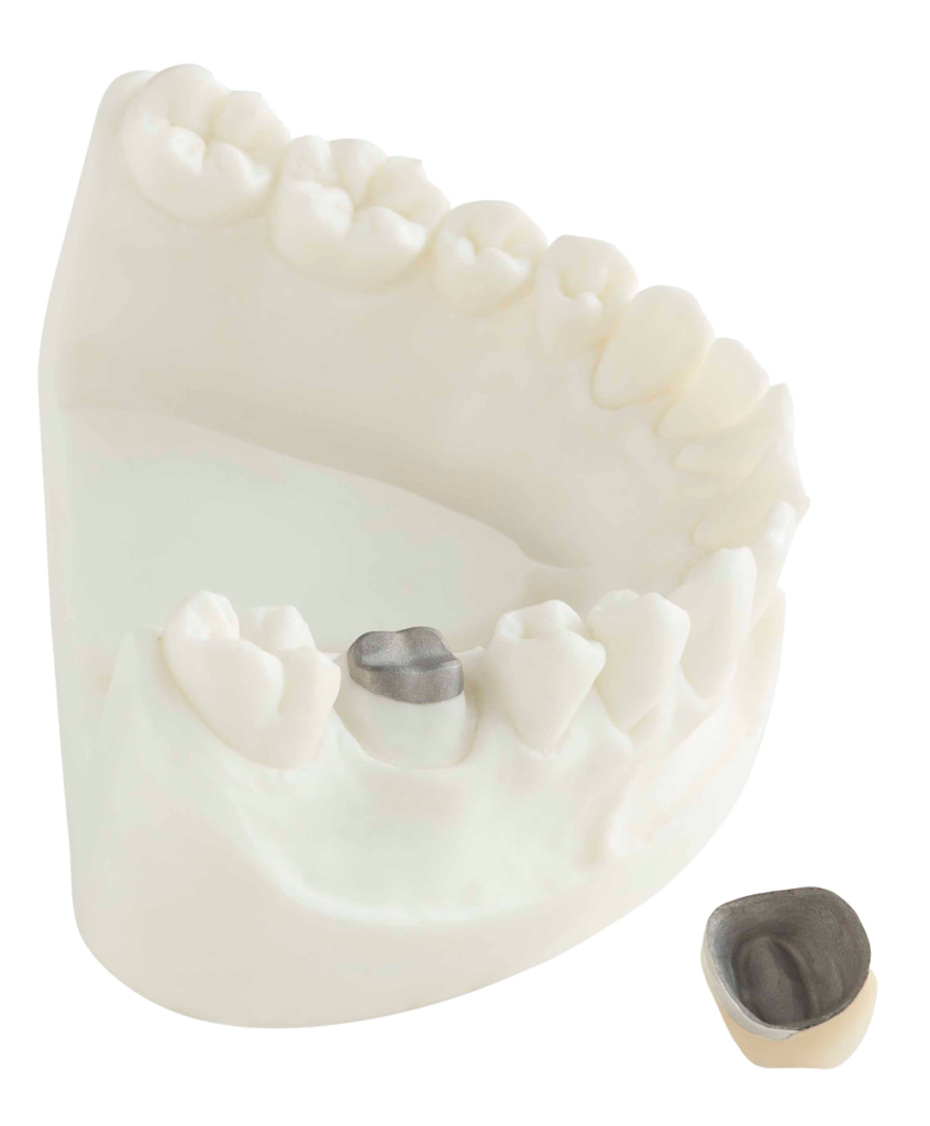 Crown and Bridgework - Metal - Metal Restorations | Gold Teeth Caps ...