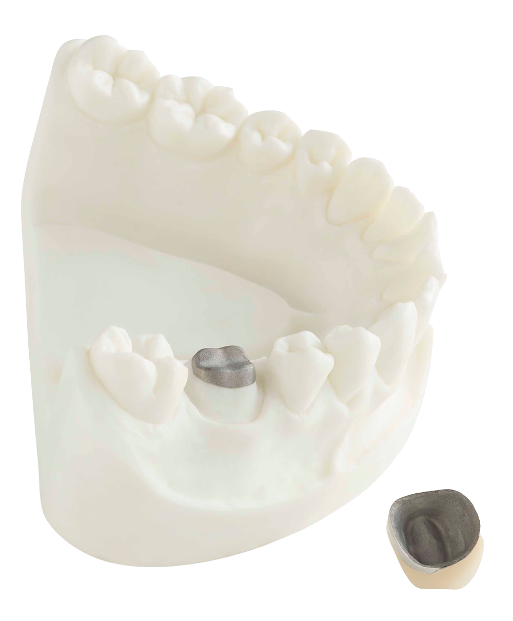 Metal Post & Core Reinforcement | Southern Cross Dental