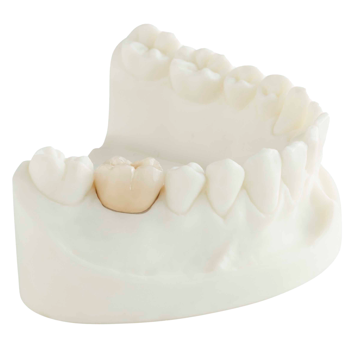 Crown and Bridgework - Metal - Metal Restorations | Gold Teeth Caps ...