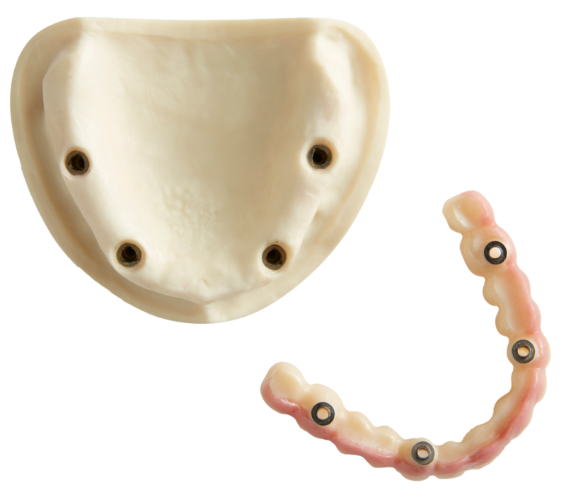 Full Arch Dental Implants Southern Cross Dental