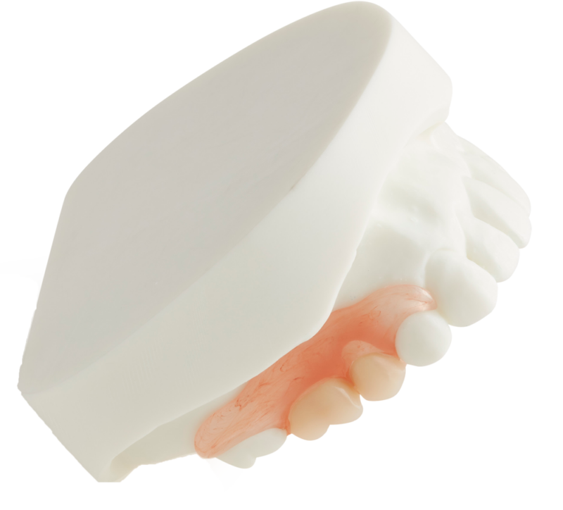 Removable Prosthodontics | Partial Dentures | Upper Partial Dentures ...