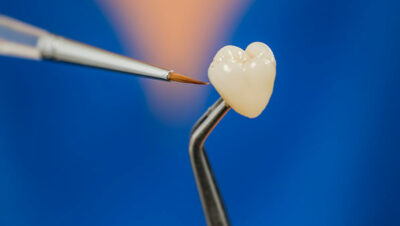 Non-metal CERAMAGE® crowns and bridgework | Southern Cross Dental